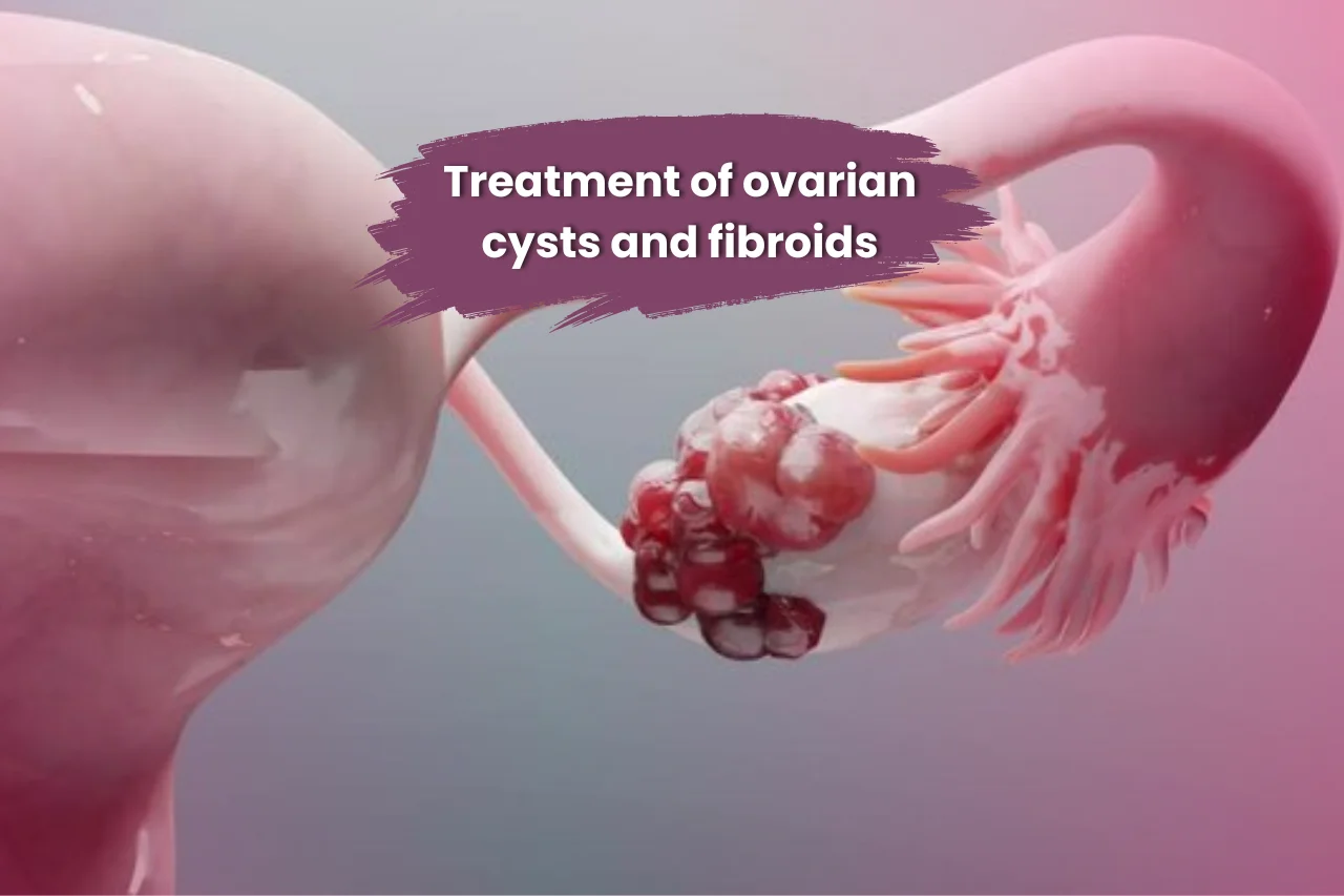 Best Gynecologist for Ovarian Cysts and Fibroids Treatment in Hyderabad ...